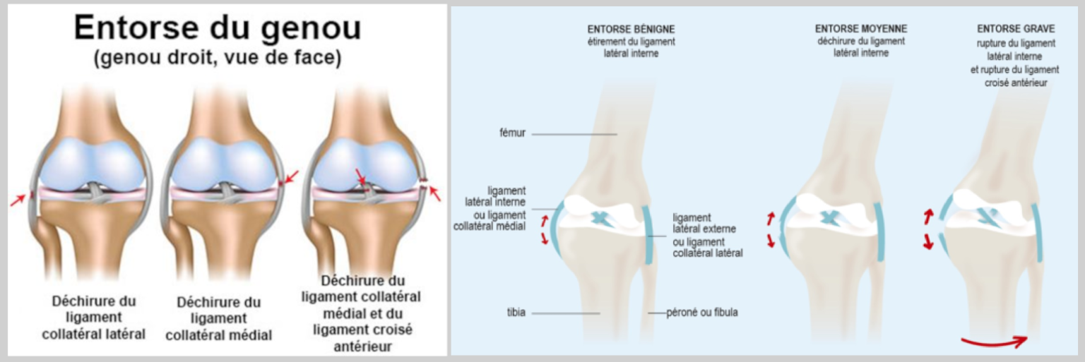 Entorses : un genou à terre - pinte de foot